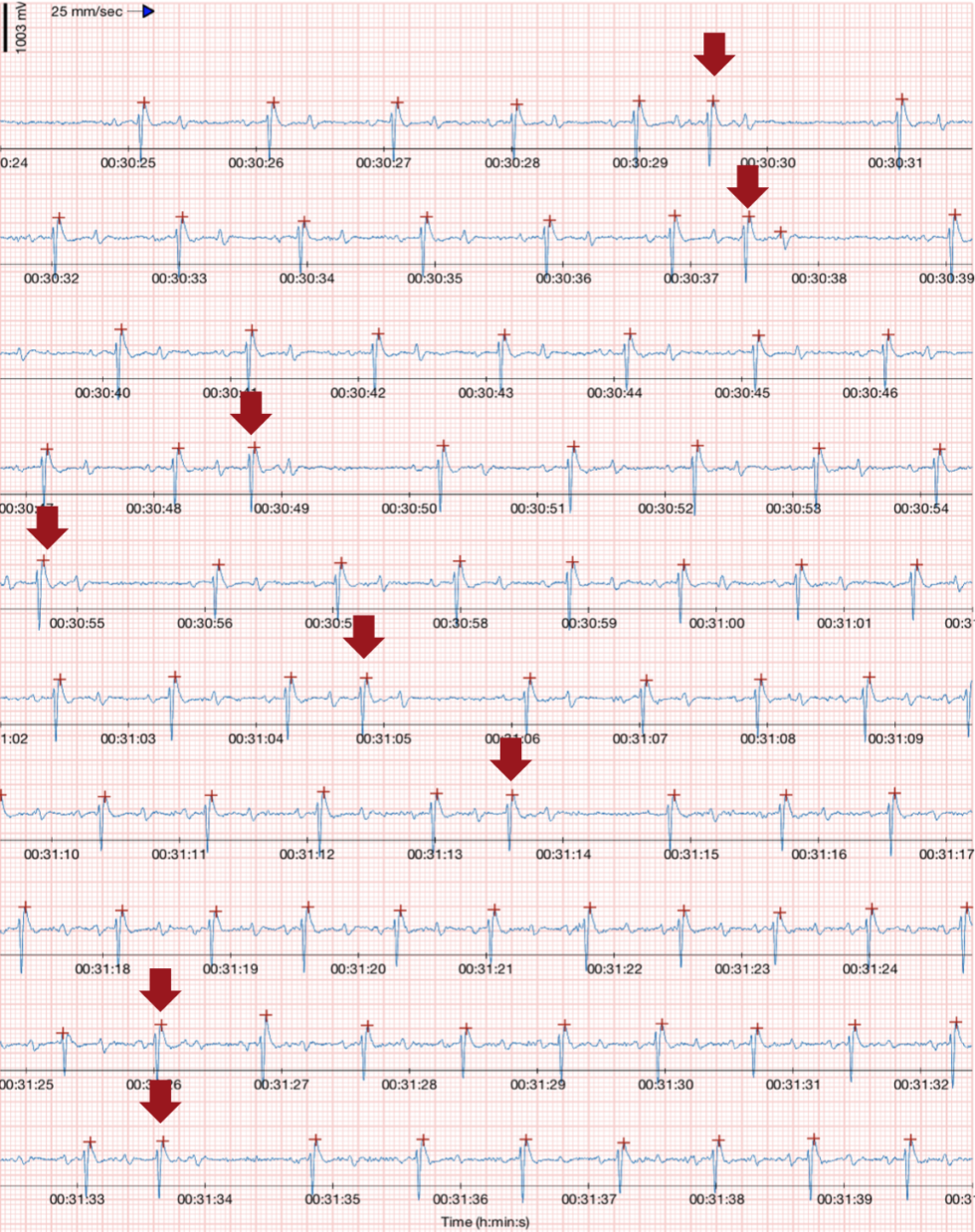 Exercise ECG: how and why work with it?